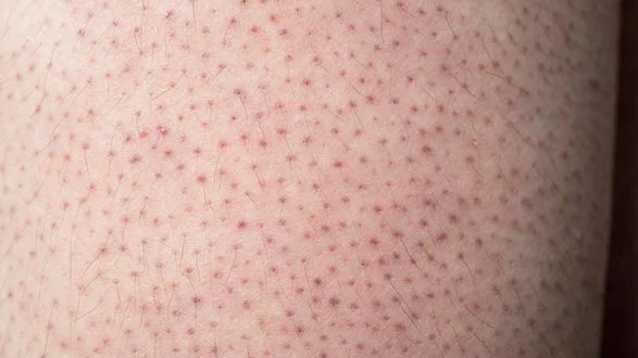 Selangor,Kuala Lumpur (KL),Subang Jaya Keratosis Pilaris (Chicken Skin ...